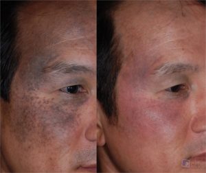 Nevus of Ota Facial Patch Treatment by Tucson Dermatologists